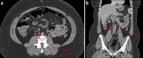 A Axial Ct Venogram Shows Small Calibre Ivc Over A Long Distance