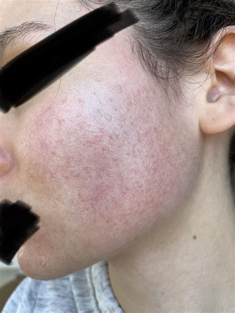 2 5 Months With Doxy And It Does Not Seem To Improve R Rosacea
