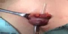 Colostomy Surgery Video DnaTube Com Scientific Video And Animation Site