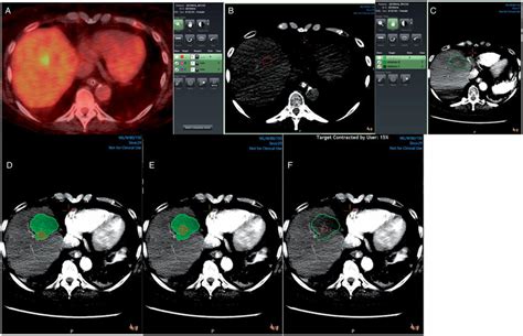 3 D Margin Assessment In A Patient With Colorectal Liver Metastasis In Download Scientific