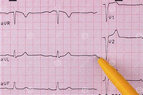 Electrocardiogram Stock Illustration Illustration Of Cardiac 51399568