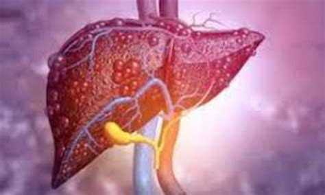 Non Statin Cholesterol Lowering Drugs Linked To Lower Liver Cancer Risk