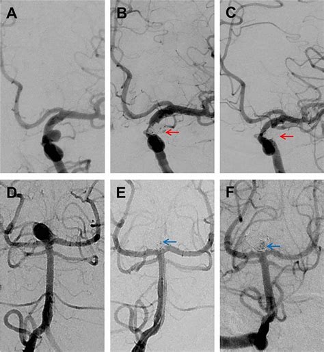 Cerebral Angiograms Demonstrating A Left Ophthalmic Artery Aneurysm Download Scientific Diagram