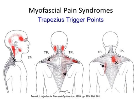 Lecture 8 Myofascial Trigger Points Flashcards Quizlet