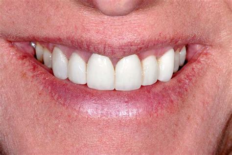 What Is Laser Frenectomy Alpenglow Dental In Bend Oregon