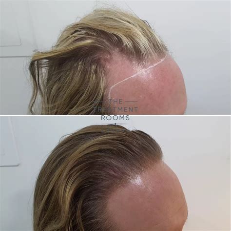 How Much Does A Transgender Hair Transplant Cost