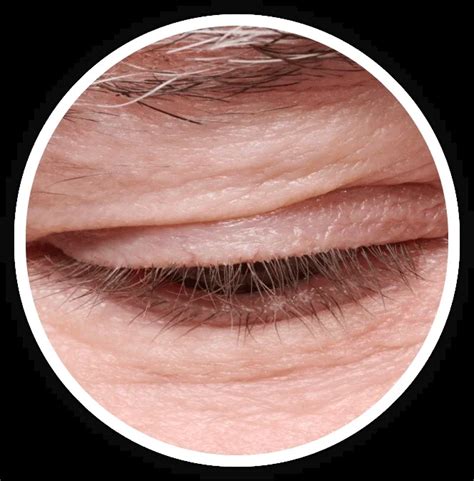 Demodex Blepharitis Xdemvy® Lotilaner Ophthalmic Solution 0 25