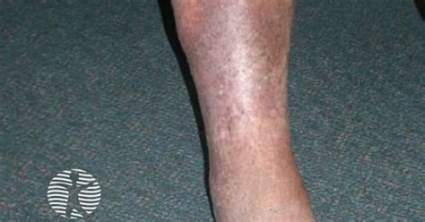 Lipodermatosclerosis Image
