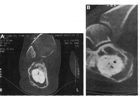 Figure 1 From Prosthetic Replacement For Intramedullary Calcaneal Osteosarcoma A Case Report