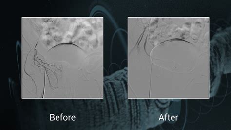 Video Prostatic Artery Embolization With Particles