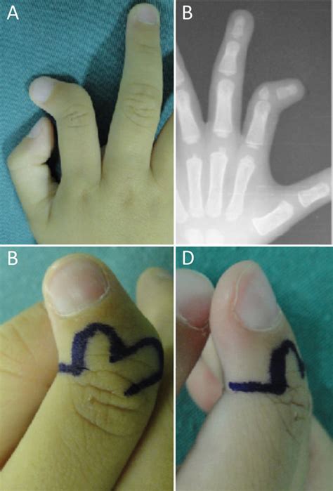 Patient With Index Finger Clinodactyly An Isolated Deformity Not Download Scientific Diagram