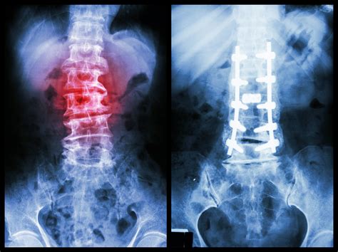 Diagnosing Spondylolysis Painscale