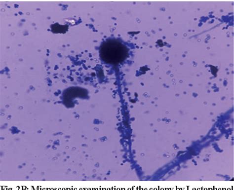 Figure 1 From Primary Laryngeal Aspergillosis In The Immunocompetent