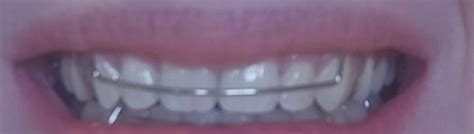 I Got My Braces Removed R Braces