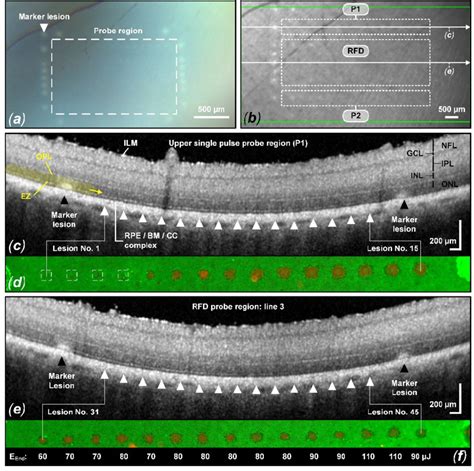 Exemplary Oct B Scan Post Treatment Tissue Assessment Of Sample No 5