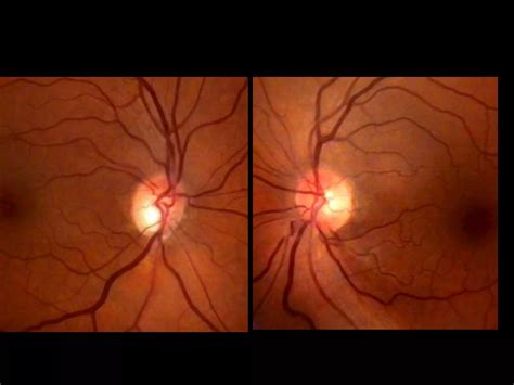 22 Optic Disc Evaluation In Glaucoma Ppt