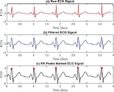Automatic Detection Of Sleep Apnea From Single Lead Ecg Signal Using Machine Learning Semantic