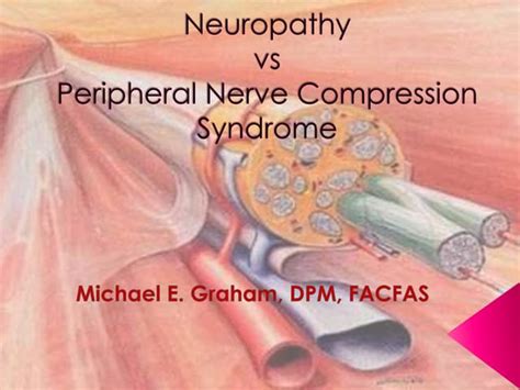Peripheral Nerve Compression Syndrome Pptx