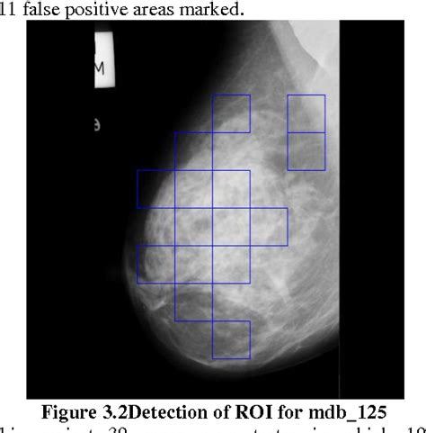 Figure 21 From Architectural Distortion Detection In Mammogram Using Contourlet Transform And