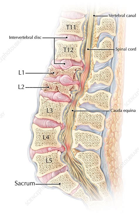 Lumbar Compression Fracture Stock Image C0249724 Science Photo Library