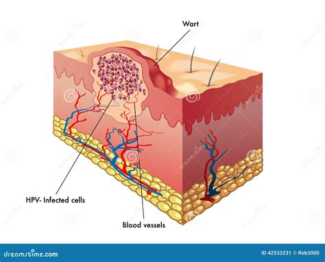 Plantar Wart Up Close Royalty Free Cartoon 56505230