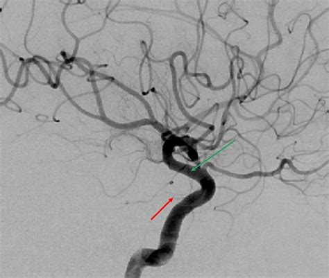 Meningohypophyseal Trunk