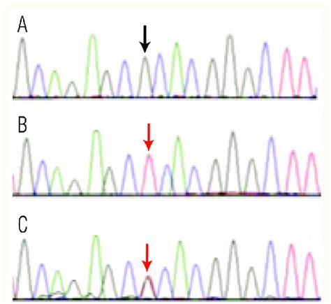Panel A B And C Sequence Profiles Showing The C 938g T Mutation In Exon Download Scientific