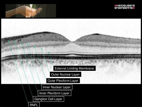 Spectralis Oct Normal Anatomy And Systematic Interpretation