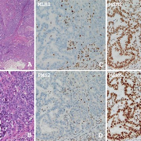 Tmb And Msi Scores In Each Case Of Endometrial Cancer Scores For Tmb