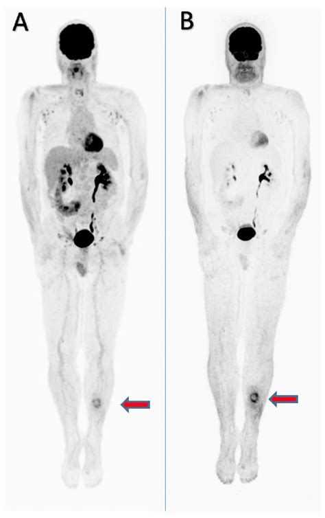 3d Maximum Intensity Projection Image Of An Adult Diagnosed With Pcl
