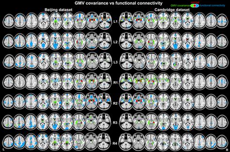 Spatial Distribution Of The Whole Brain Gray Matter Volume Gmv