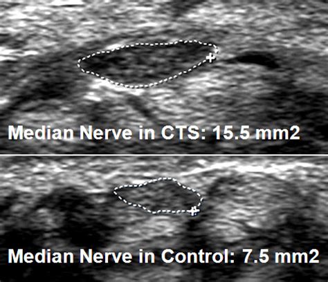 Median Nerve