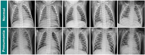 Samples Of Each Class Of The CXR Dataset From Left To Right Sets Of Download Scientific