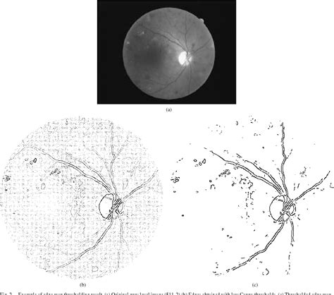 Figure 2 From Fast And Robust Optic Disc Detection Using Pyramidal Decomposition And Hausdorff
