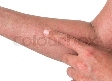 Close Up Human Skin With Red Rashes From Dengue Disease Colourbox