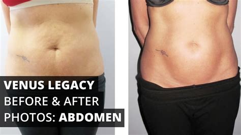 Venus Legacy™ Before And After Photos Abdomen Youtube