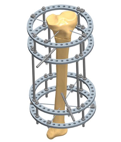 Tibia Bone Fracture Treatment Orthofix ABS