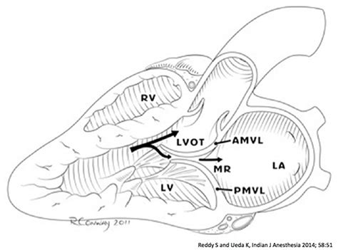 Dynamic Left Ventricular Outflow Tract Obstruction Lvoto Emcrit Project