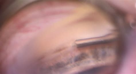 Navigating The World Of Goniotomytrabeculotomy And Canaloplasty Eyeworld