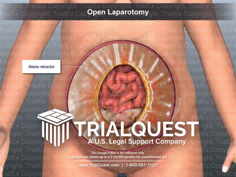 Open Laparotomy Anerior View Female Trial Exhibits Inc