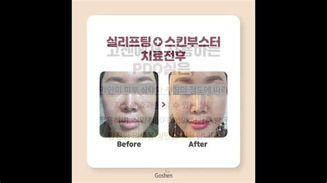 인천 팔자주름 고민 실리프팅 치료사례and전후사진 Youtube