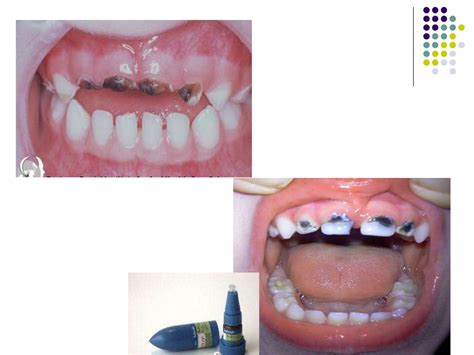 Кариес зубов у детей Лечение презентация онлайн