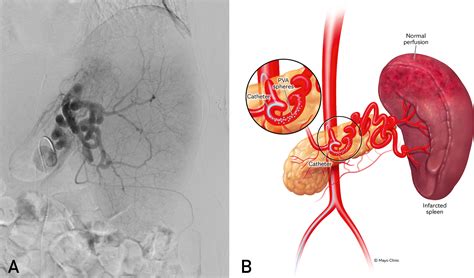 Interventional Radiology Partial Splenic Embolization For Refractory
