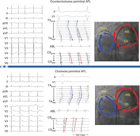 Macroreentrant Atrial Tachycardia Thoracic Key