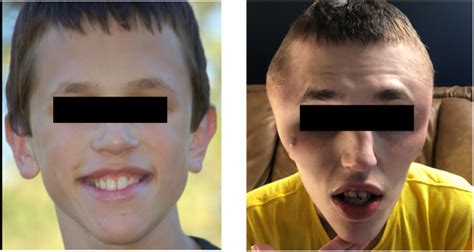 Concurrent Developmental Regression And Neurocognitive Decline In A