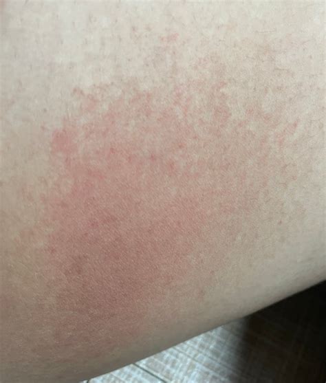 허벅지 안쪽 발진 지식in