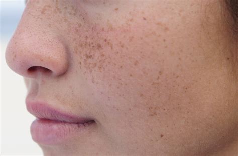 봄만 되면 심해지는 기미·주근깨 쉽게 구분하는 방법 당신의 건강가이드 헬스조선