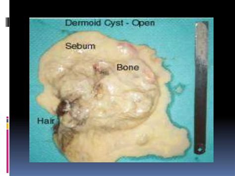 Dermoid Cyst Pptx