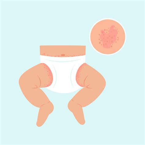 Diaper Rash Red Blisters At Alexis Kevin Blog