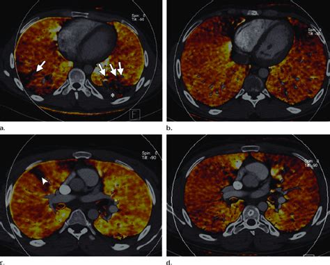 Segmental Perfusion Defects In A 45 Year Old Woman With A Pulmonary